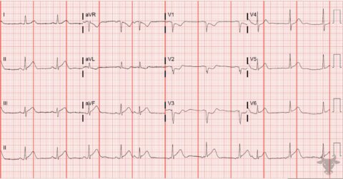ST-elevation Myocardial Infarction | ECG Stampede