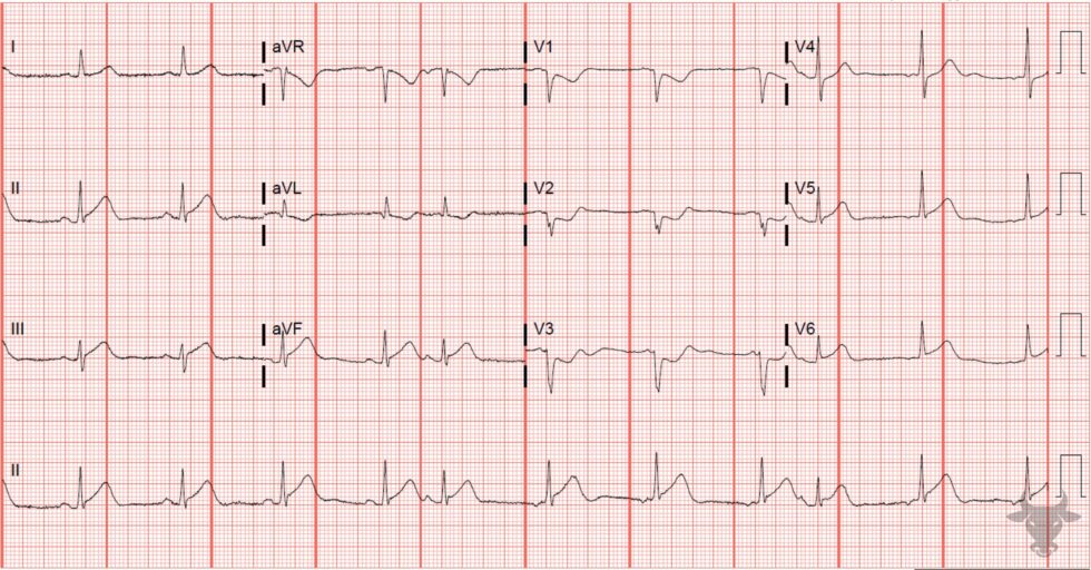 ST-elevation Myocardial Infarction | ECG Stampede