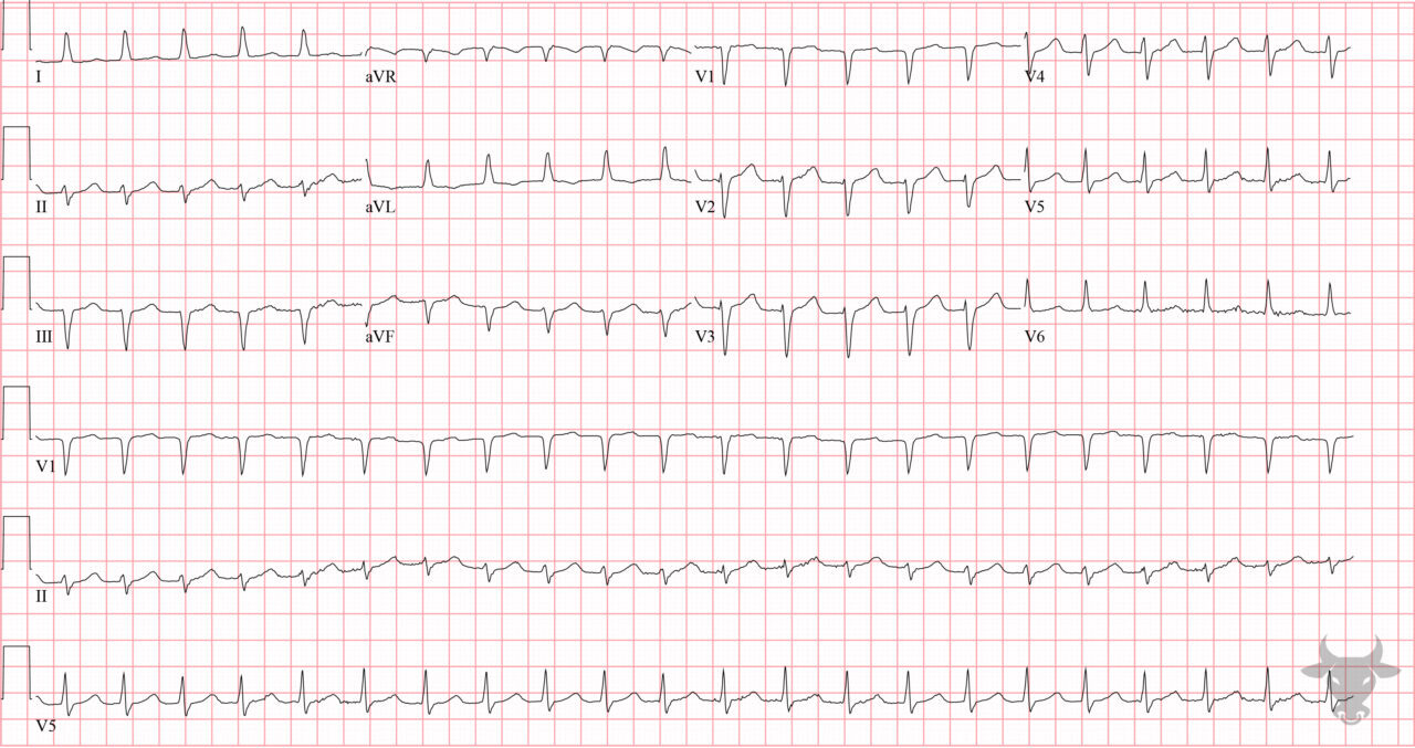 Atrioventricular Nodal Reentrant Tachycardia | ECG Stampede