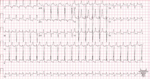 Hyperkalemia | ECG Stampede