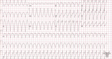 Ventricular Tachycardia | ECG Stampede