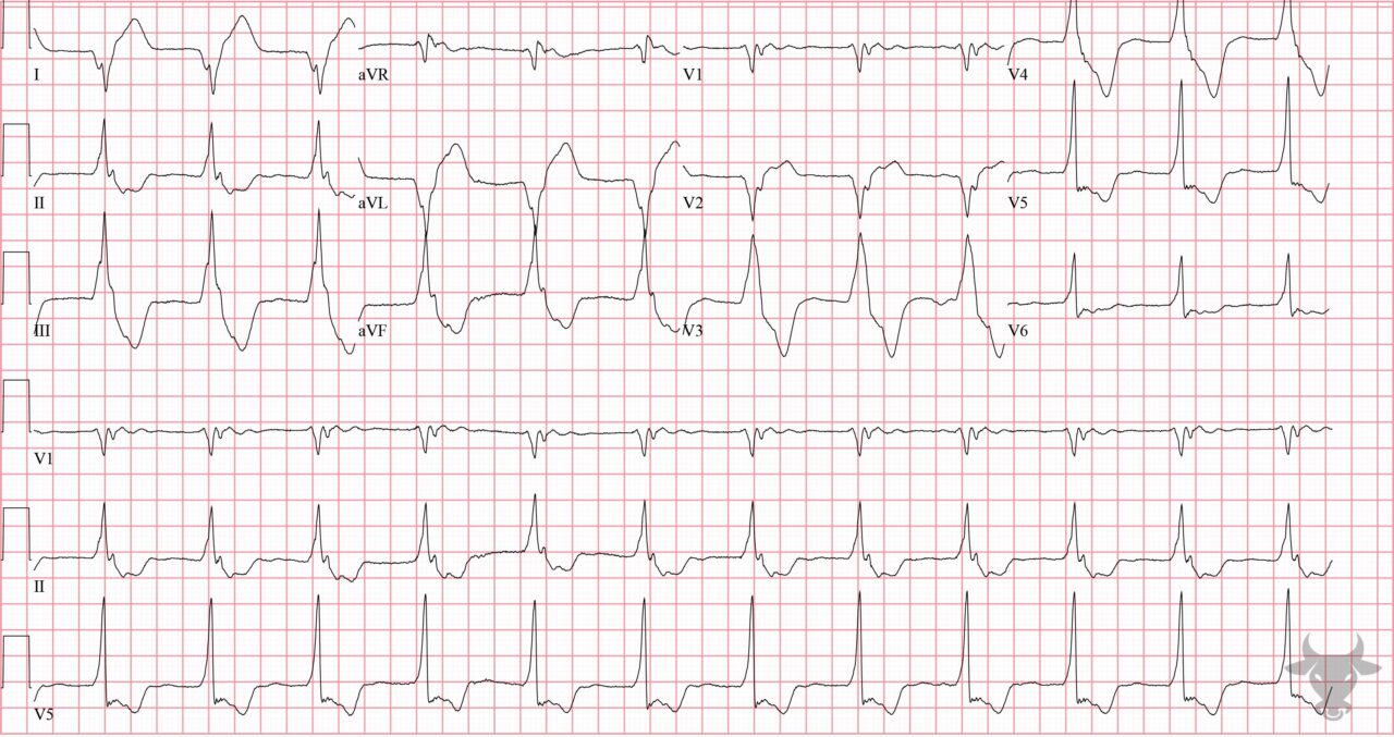 ST-elevation Myocardial Infarction | ECG Stampede
