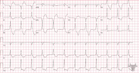 Accelerated Idioventricular Rhythm | ECG Stampede