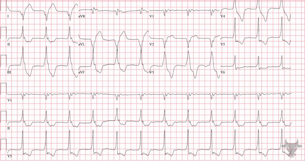 Accelerated Idioventricular Rhythm | ECG Stampede