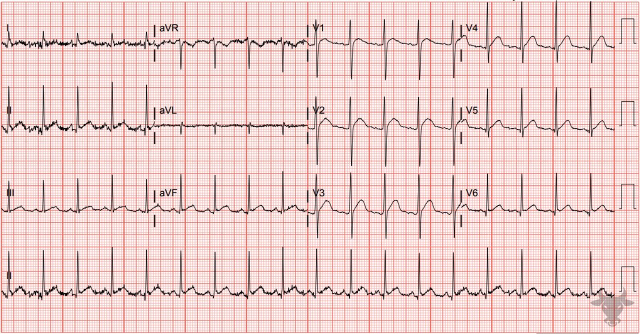 Hypercalcemia | ECG Stampede