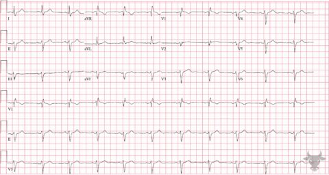Left Anterior Fascicular Block | ECG Stampede
