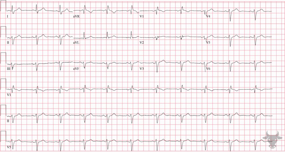Left Anterior Fascicular Block | ECG Stampede