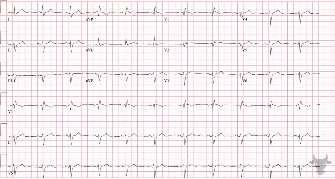 Right Bundle Branch Block | ECG Stampede