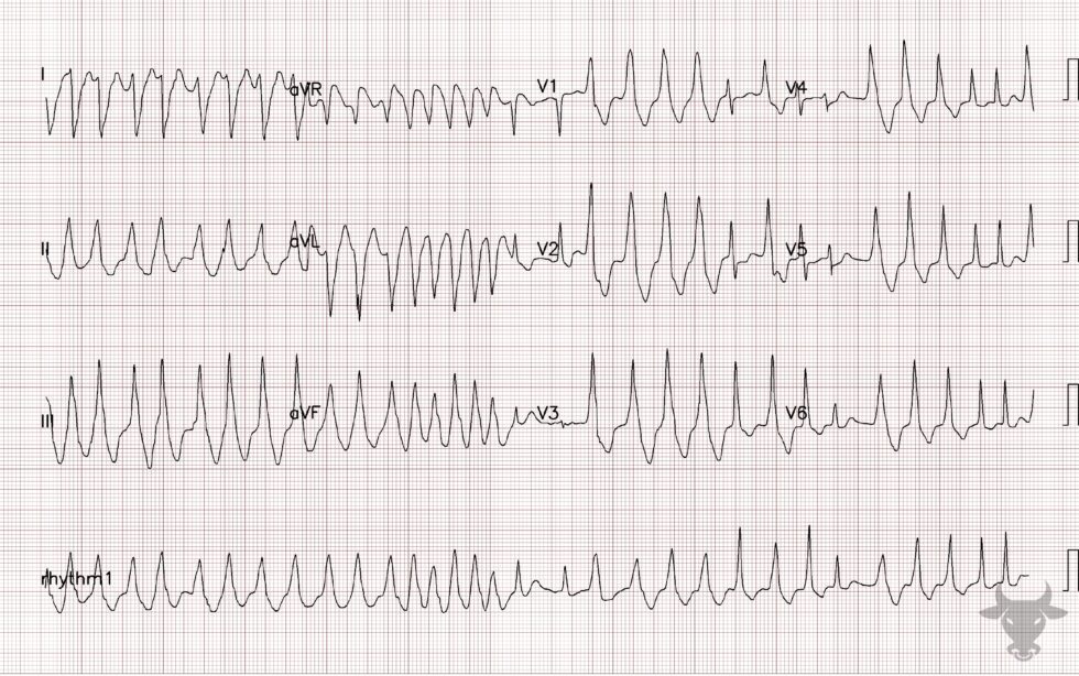 Ventricular Pre-excitation | ECG Stampede