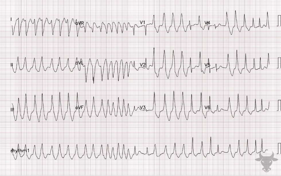 Atrial Fibrillation | ECG Stampede