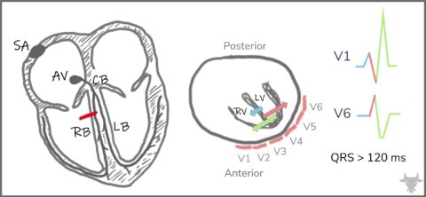 Right Bundle Branch Block | ECG Stampede