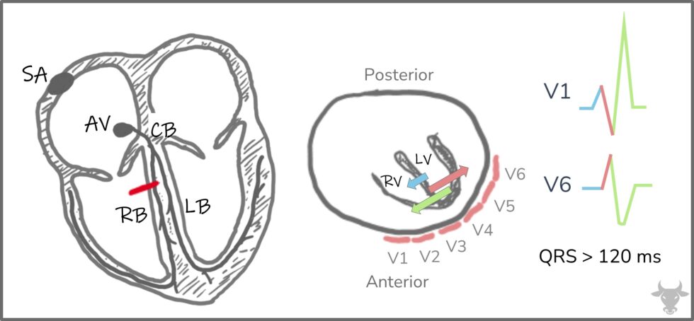 Right Bundle Branch Block | ECG Stampede