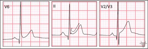 Early Repolarization | ECG Stampede