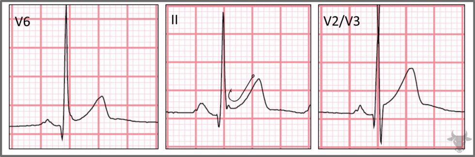 Early Repolarization | ECG Stampede