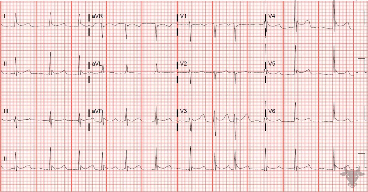 Hypothermia | ECG Stampede
