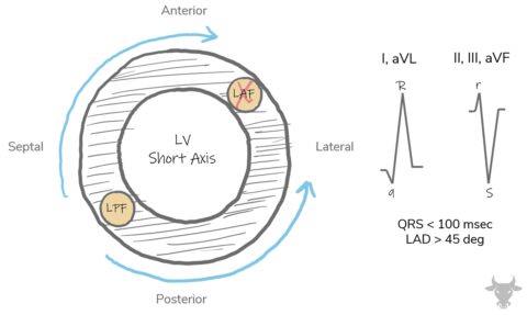 Left Anterior Fascicular Block | ECG Stampede