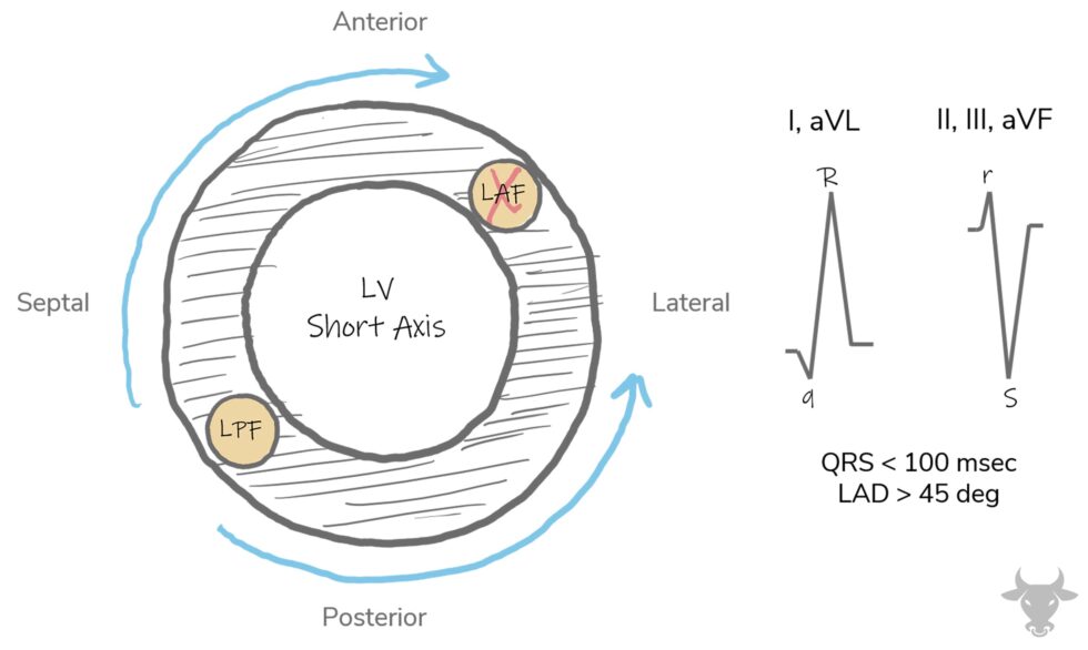 Left Anterior Fascicular Block | ECG Stampede