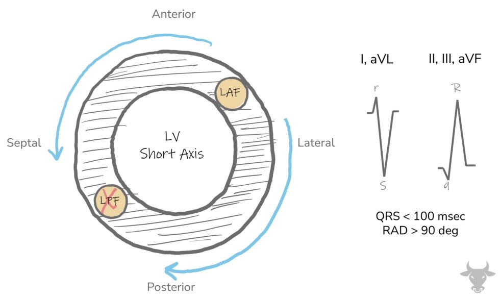 Left Posterior Fascicular Block | ECG Stampede