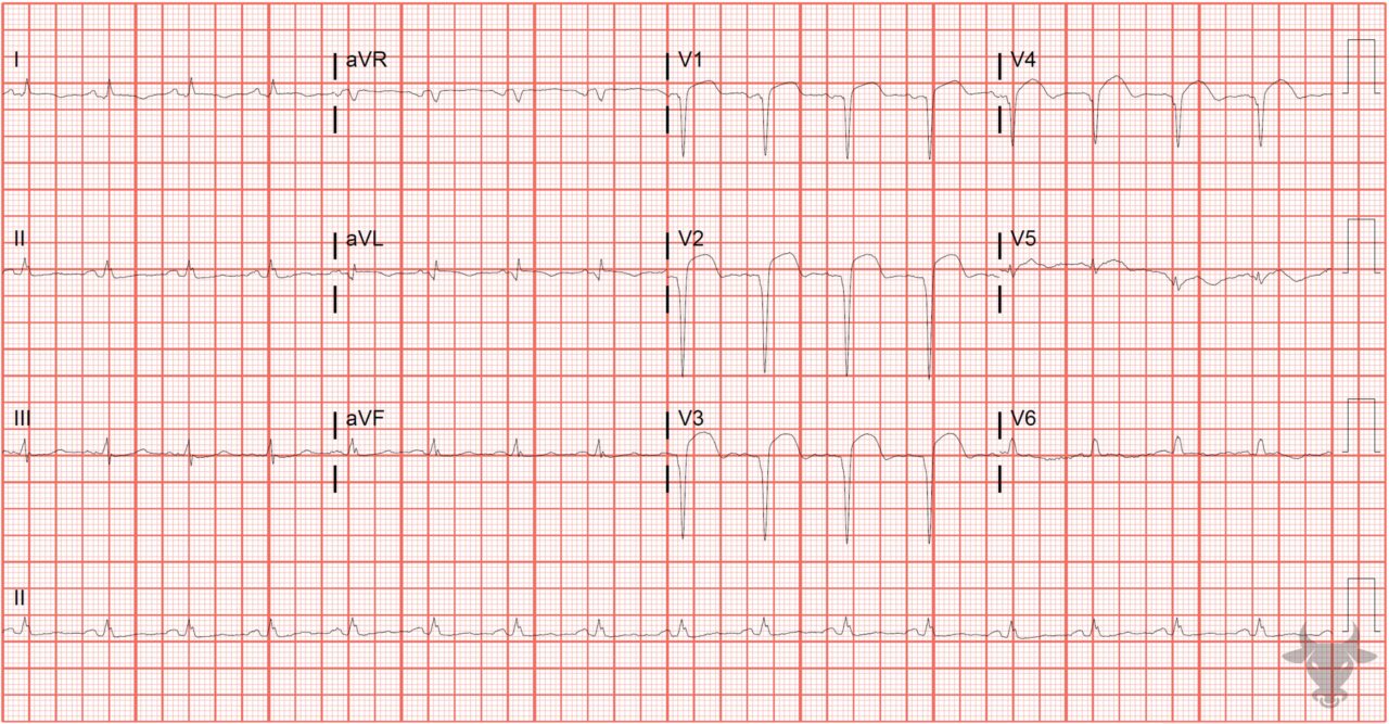 Left Ventricular Aneurysm | ECG Stampede