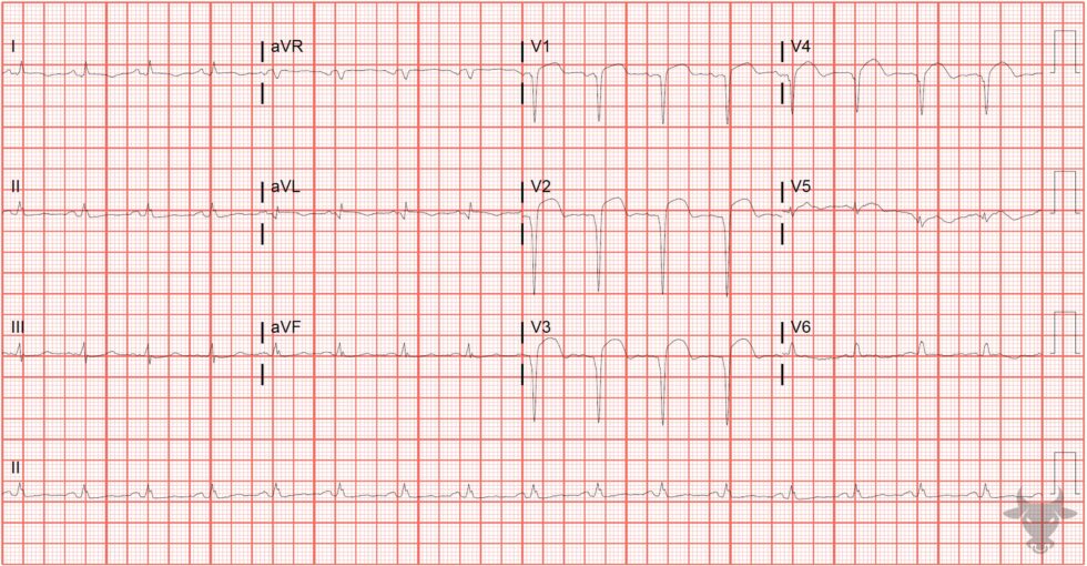 Left Ventricular Aneurysm | ECG Stampede
