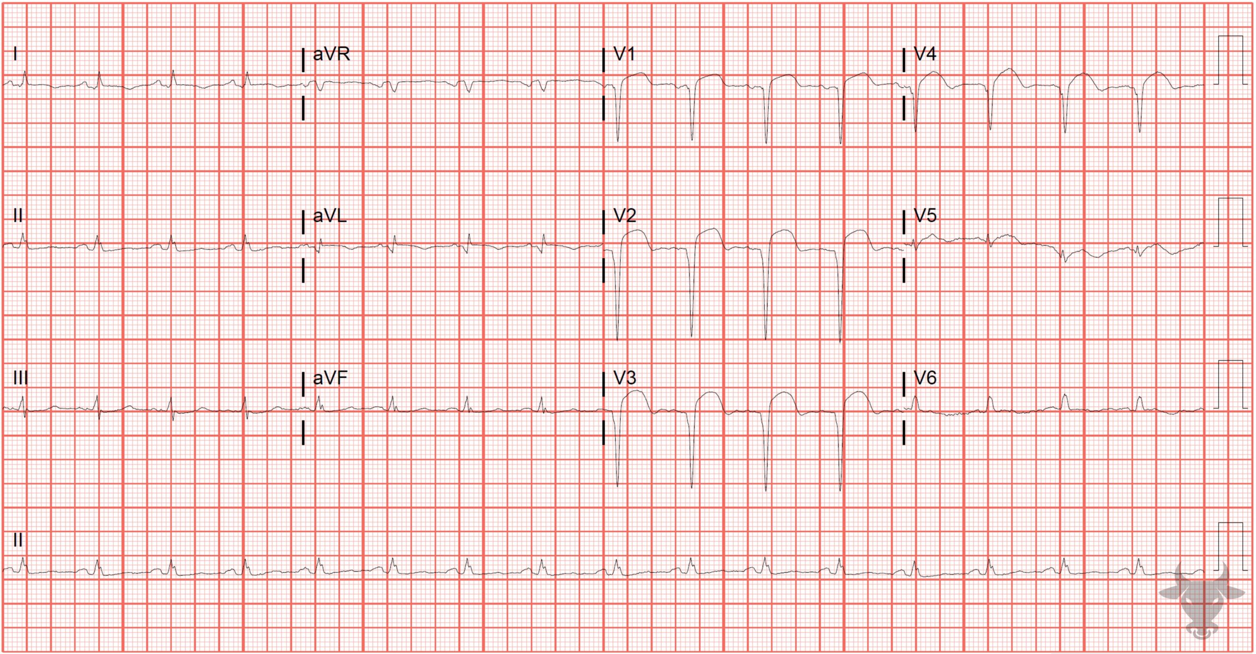Left Ventricular Aneurysm ECG Stampede