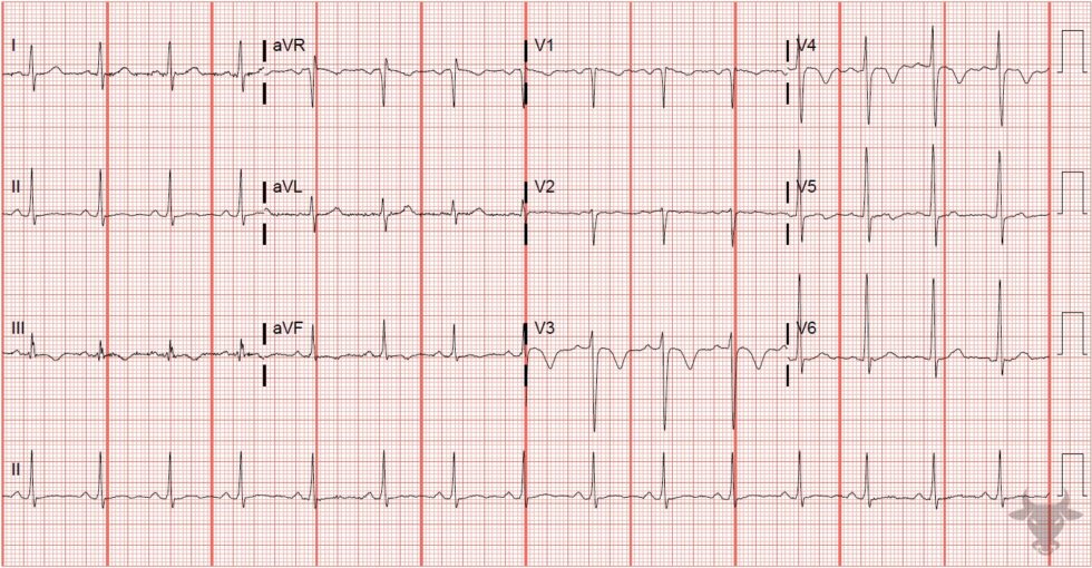 Right Heart Strain | ECG Stampede
