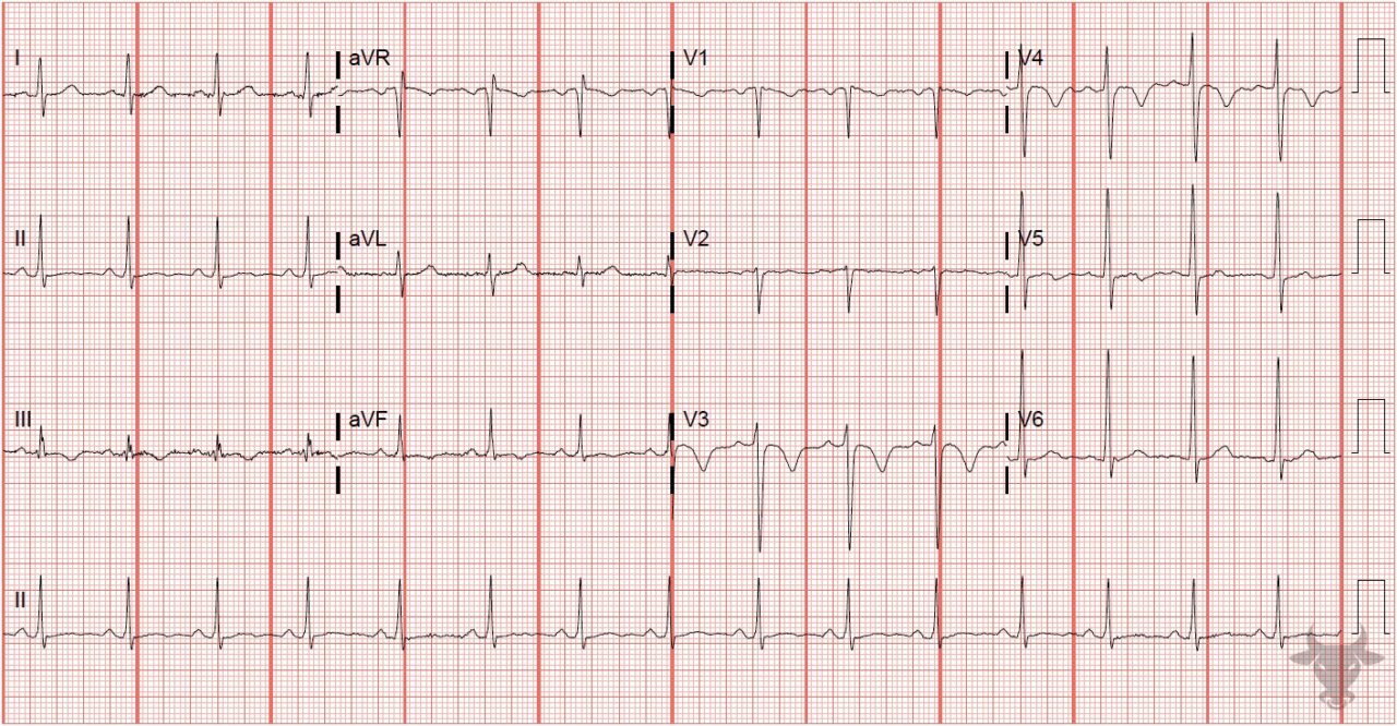 Pulmonary Embolism | ECG Stampede