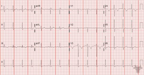 Pulmonary Embolism | ECG Stampede
