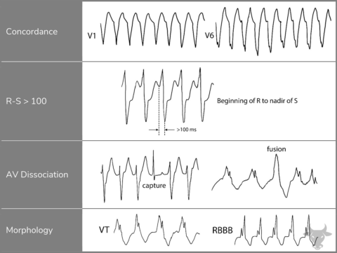 Ventricular Tachycardia | ECG Stampede