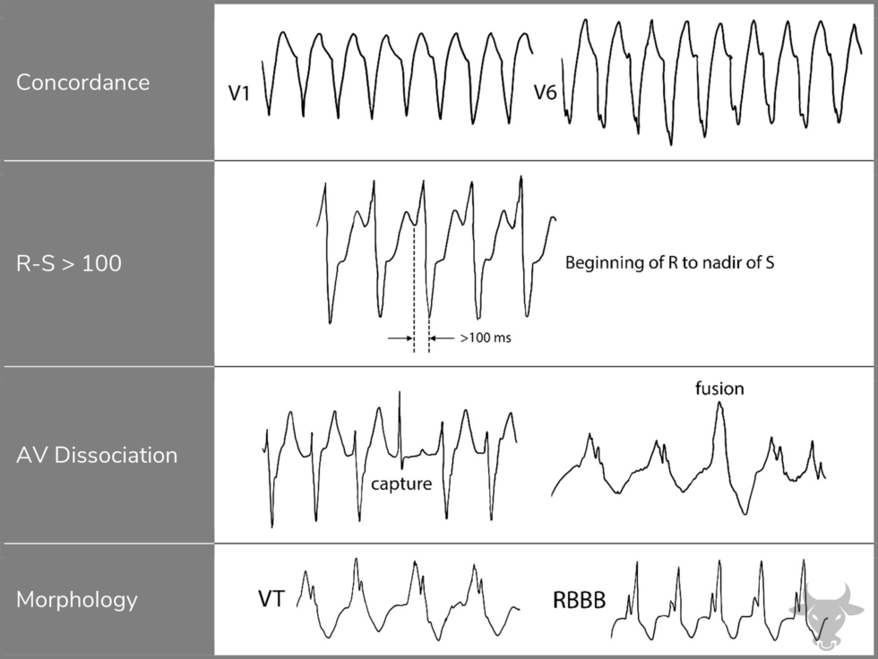 Ventricular Tachycardia | ECG Stampede