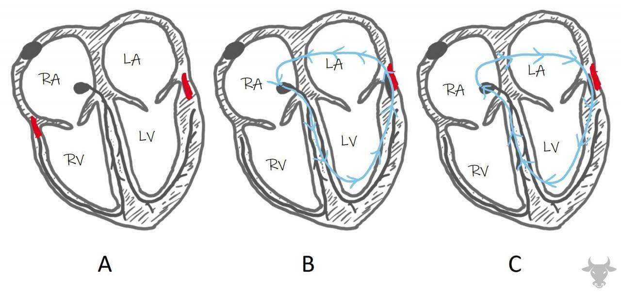 Ventricular Pre-excitation | ECG Stampede