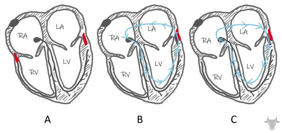 Atrioventricular Reentrant Tachycardia | ECG Stampede