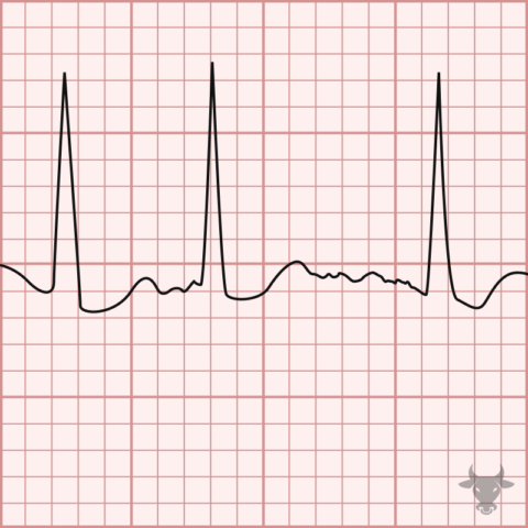 Atrial Fibrillation | ECG Stampede
