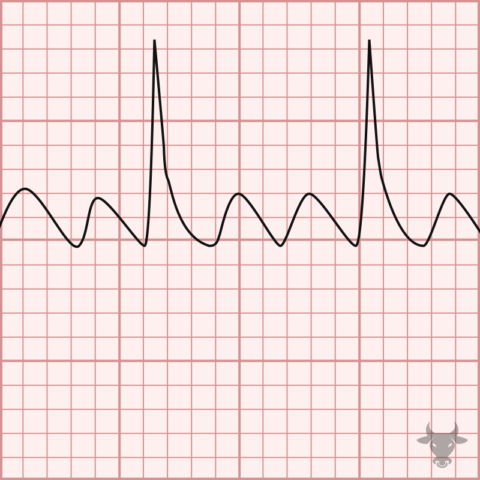 Atrial Flutter | ECG Stampede