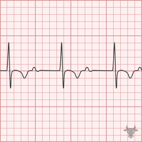 First Degree Atrioventricular Block | ECG Stampede