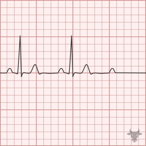 Second Degree Atrioventricular Block – Mobitz II | ECG Stampede