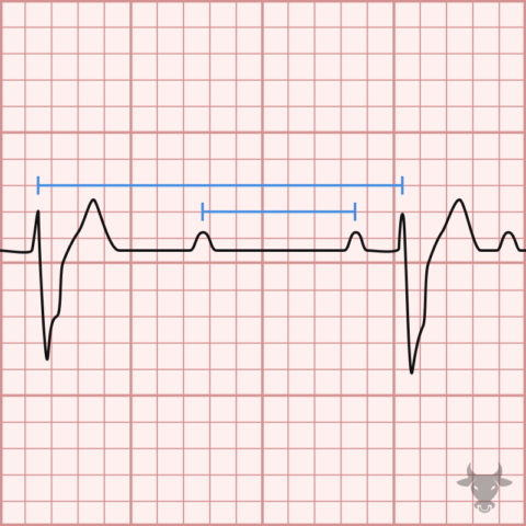 Third Degree Atrioventricular Block | ECG Stampede