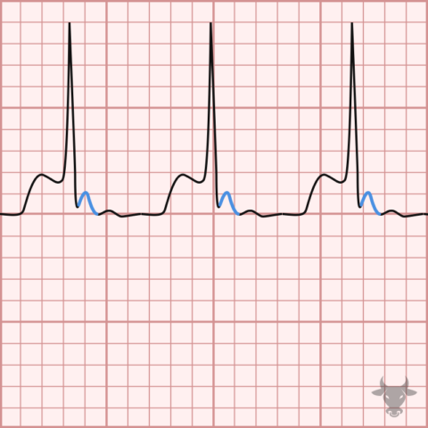 Atrioventricular Nodal Reentrant Tachycardia | ECG Stampede
