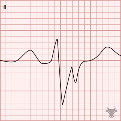 Bifascicular Block | ECG Stampede