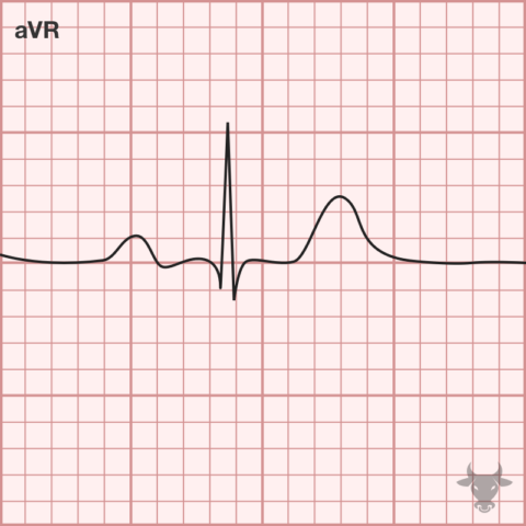 Limb Lead Reversal | ECG Stampede