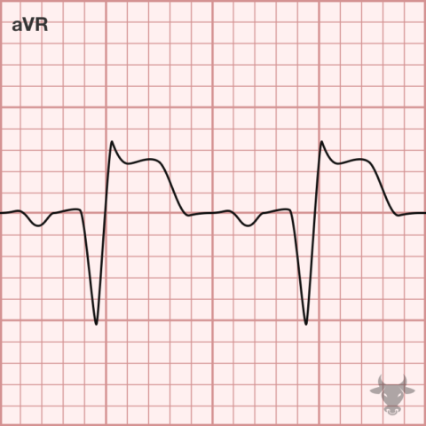 Global Subendocardial Ischemia | ECG Stampede