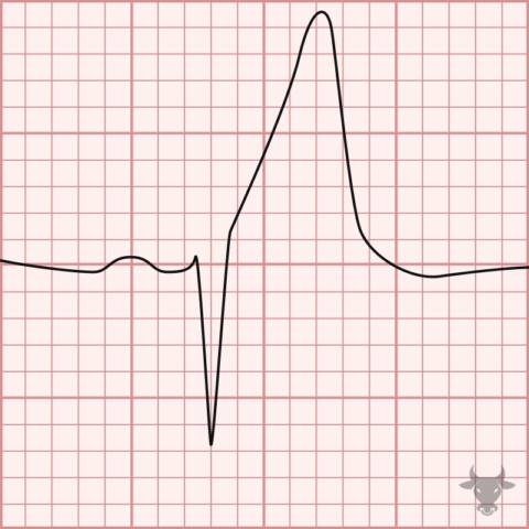 Hyperacute T Waves | ECG Stampede