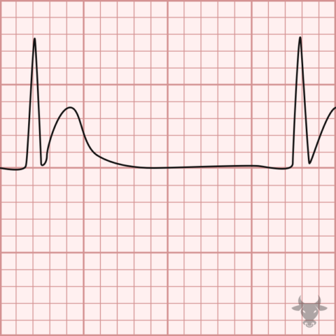 Hypercalcemia | ECG Stampede
