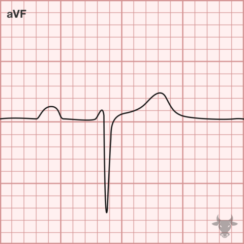 Left Anterior Fascicular Block | ECG Stampede
