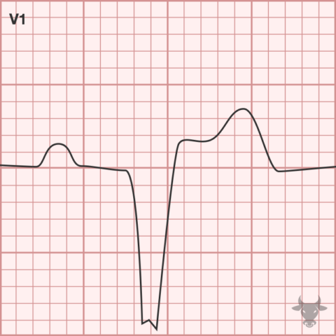 Left Bundle Branch Block | ECG Stampede