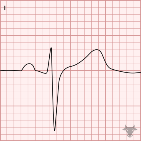 Left Posterior Fascicular Block | ECG Stampede