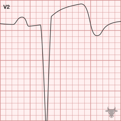 Left Ventricular Aneurysm | ECG Stampede