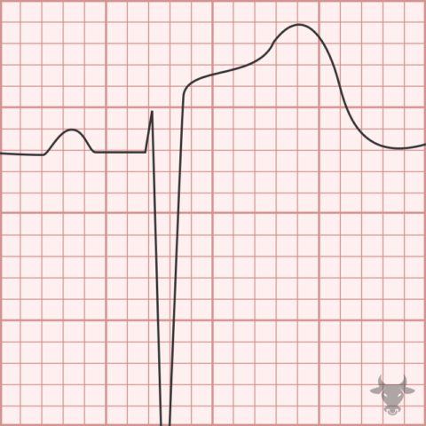 Left Ventricular Hypertrophy | ECG Stampede