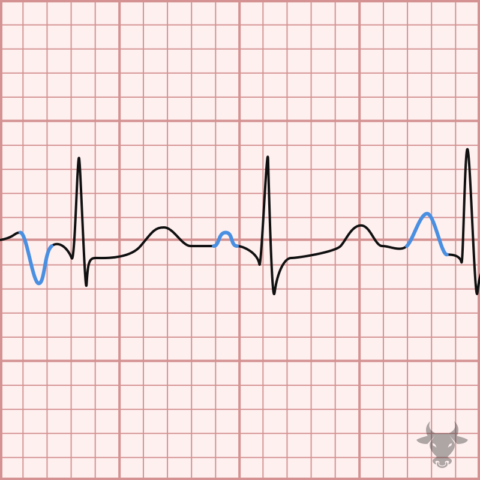Multifocal Atrial Tachycardia | ECG Stampede
