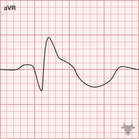 Sodium Channel Toxicity | ECG Stampede